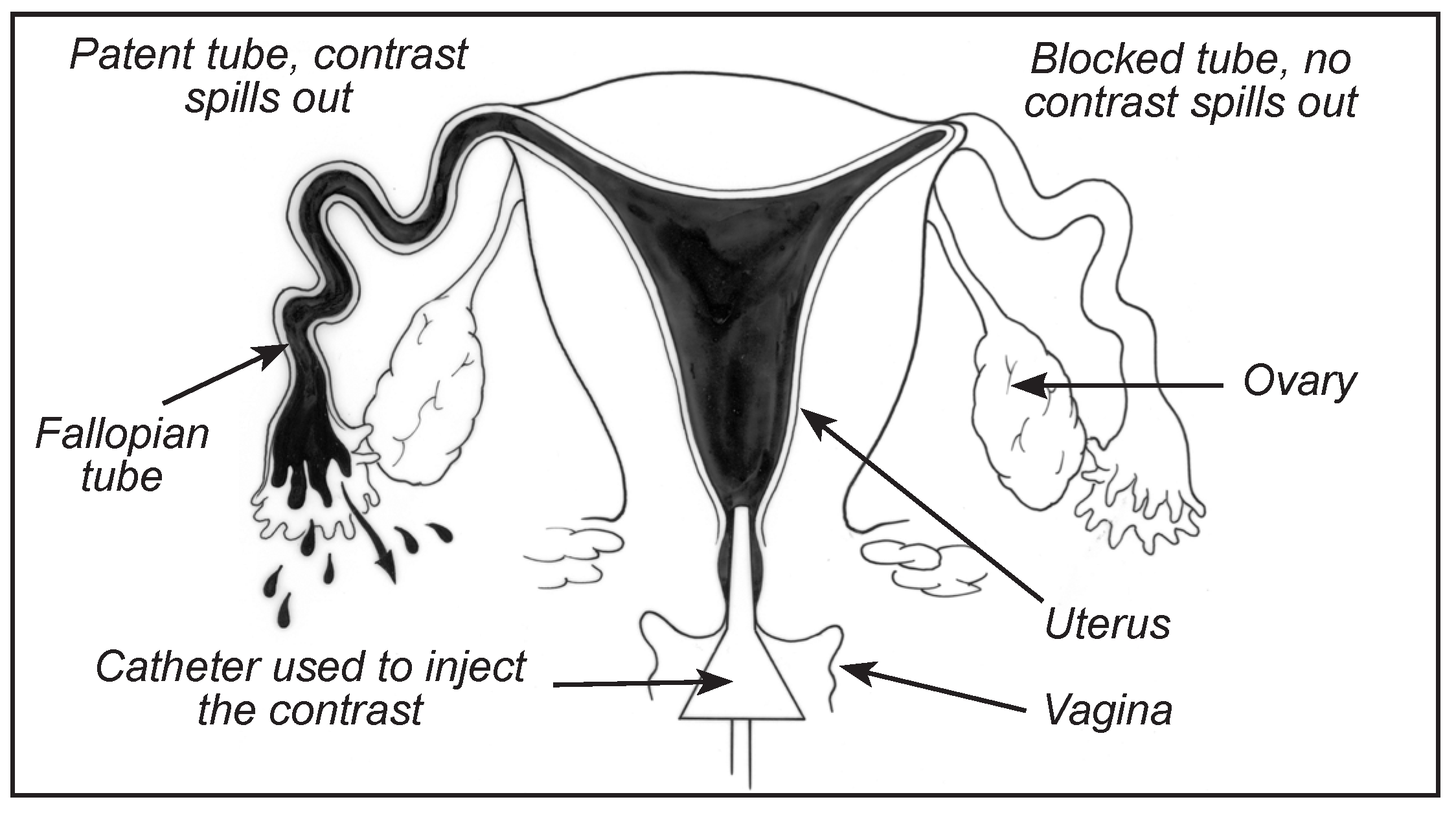 Hysterosalpingogram (HSG) | ReproductiveFacts.org